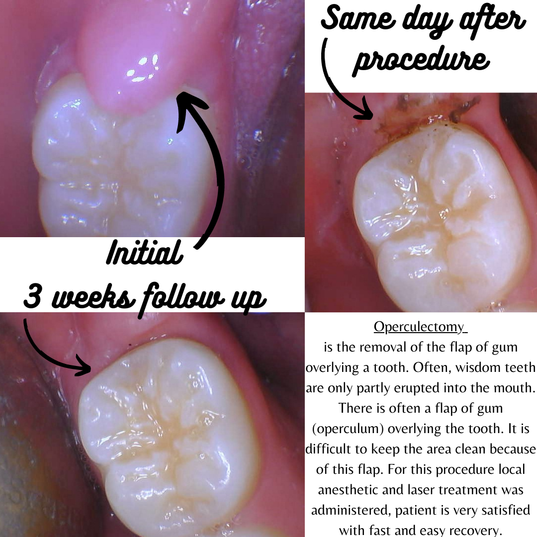 Laser Dentistry | Dentist in Miami, FL